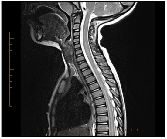 Early Therapeutic Plasma Exchange in Pediatric Transverse Myelitis: A Case Report and Scoping Review