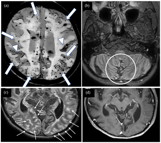 Iatrogenic Cerebral Amyloid Angiopathy After Childhood Brain Surgery ...