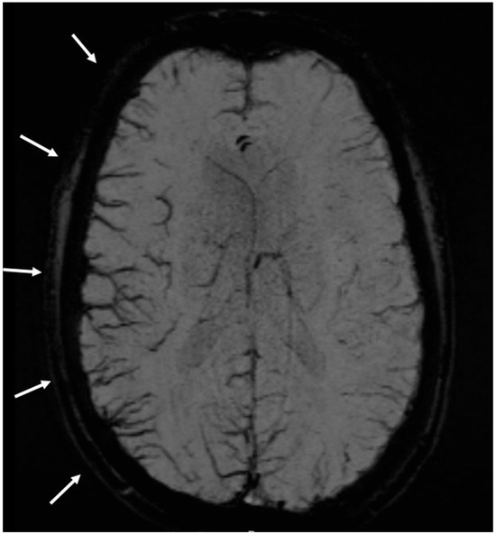 Susceptibility Weighted Imaging in Migraine with and Without Aura: A ...