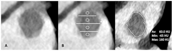 Exploring Left Atrial Appendage Thrombi in Large Vessel Occlusion ...