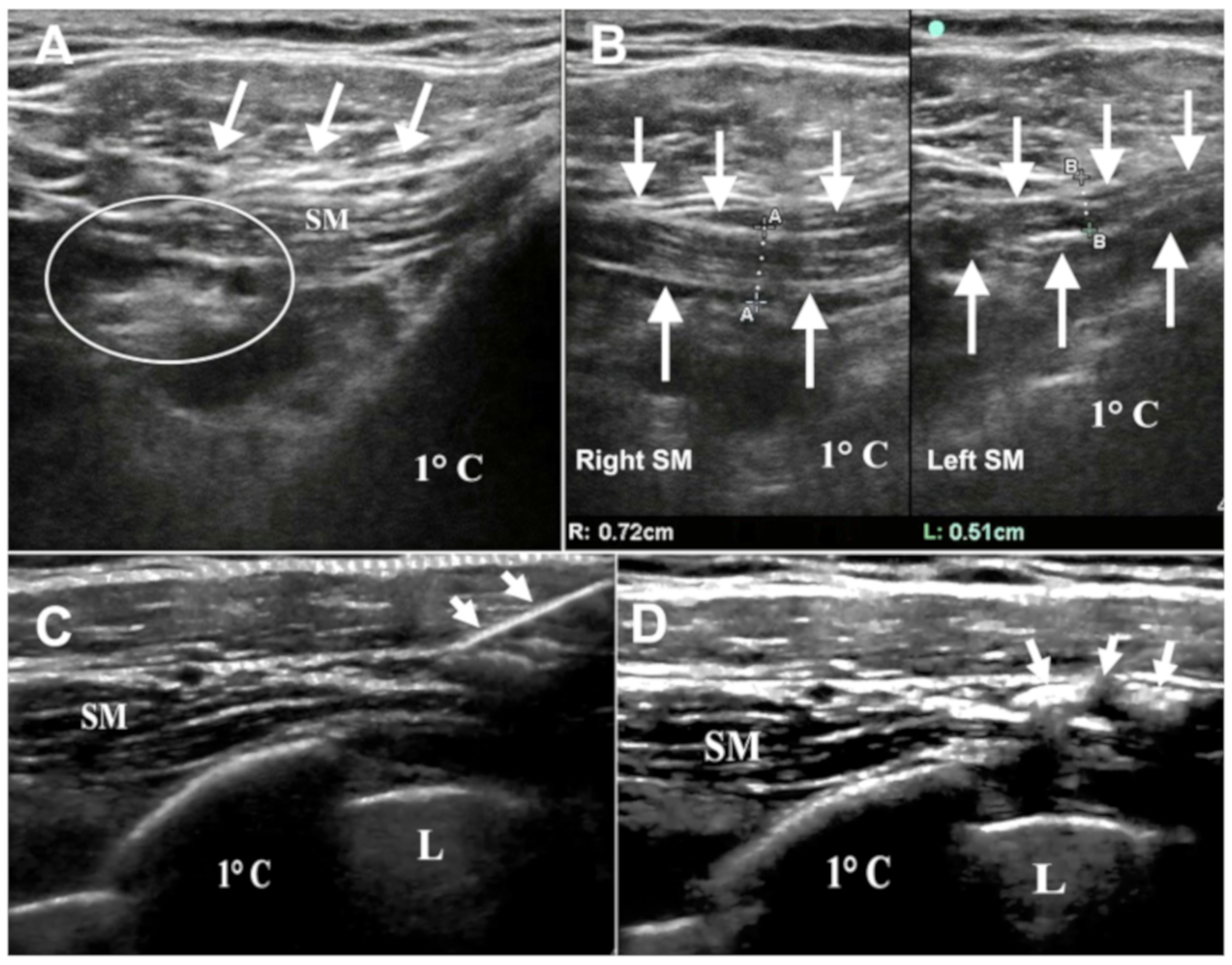 NeuroSci | Free Full-Text | Botulinum Toxin Treatment for Thoracic ...