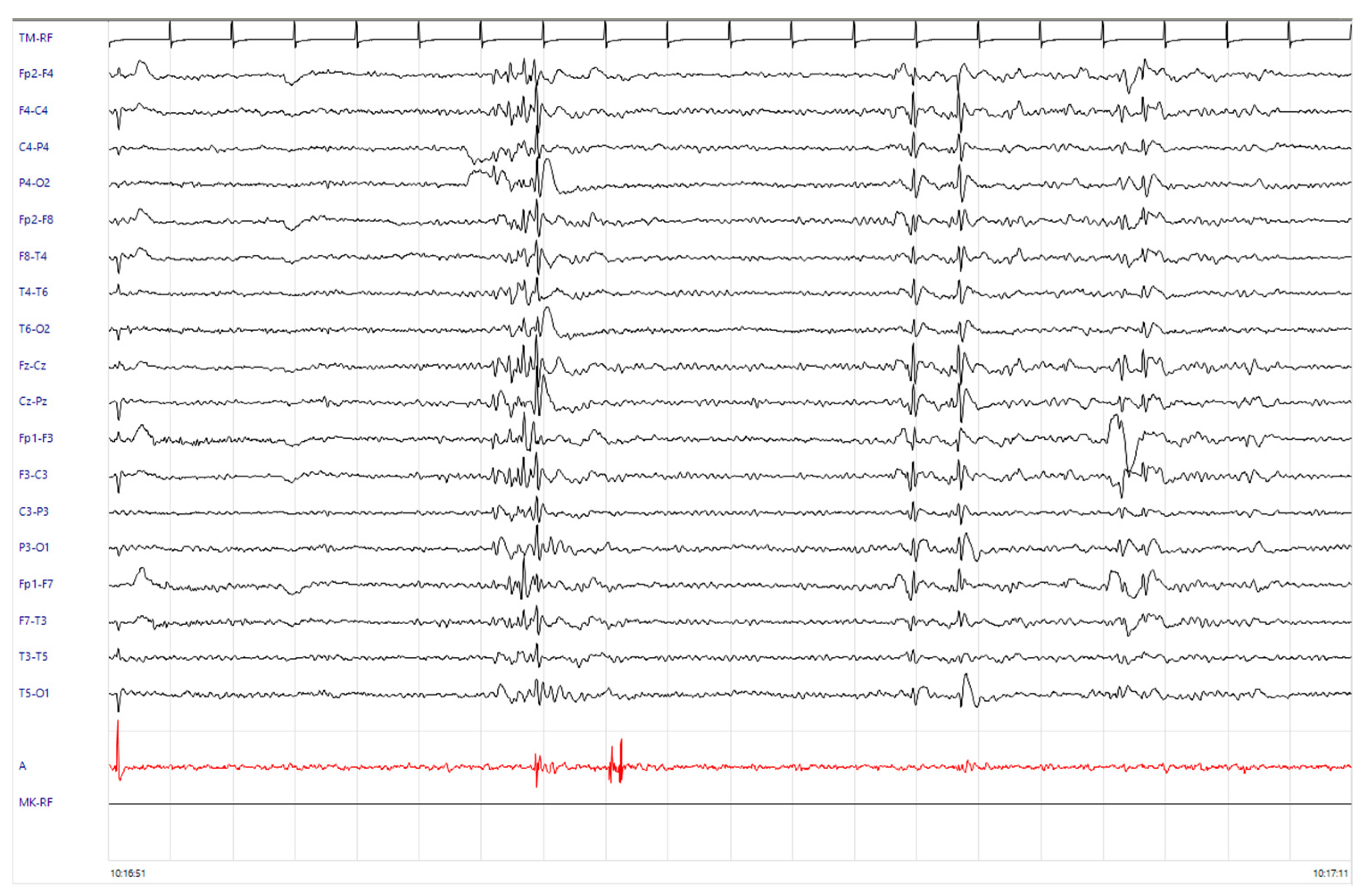 Recurrent Falls as the Only Clinical Sign of Cortical–Subcortical ...