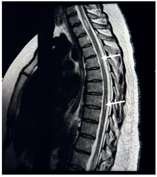 Exploring Spinal Cord Changes in Multiple Sclerosis Patients Using MRI