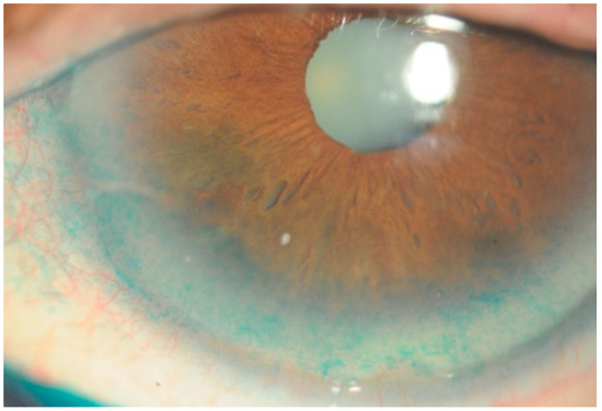 The Eye, Oxidative Damage and Polyunsaturated Fatty Acids