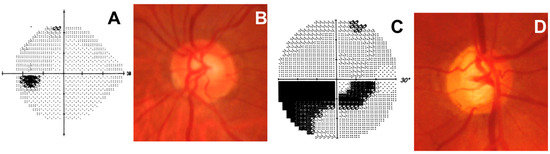 The Eye, Oxidative Damage and Polyunsaturated Fatty Acids