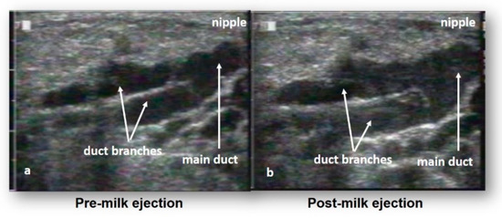 25 Years of Research in Human Lactation: From Discovery to Translation