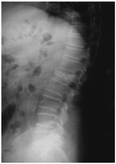 Pathophysiology of Vascular Calcification and Bone Loss: Linked ...