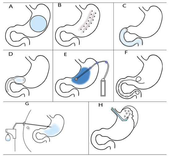 Endoscopic Treatment of Obesity and Nutritional Aspects of Bariatric ...