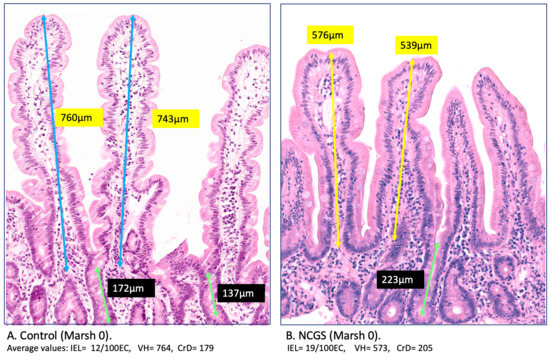 Gluten Induces Subtle Histological Changes in Duodenal Mucosa of ...