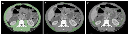 Impact of Sarcopenia on Clinical Outcomes in a Cohort of Caucasian ...