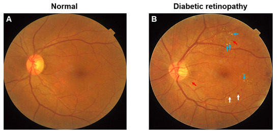 Dietary Intake and Diabetic Retinopathy: A Systematic Review of the ...