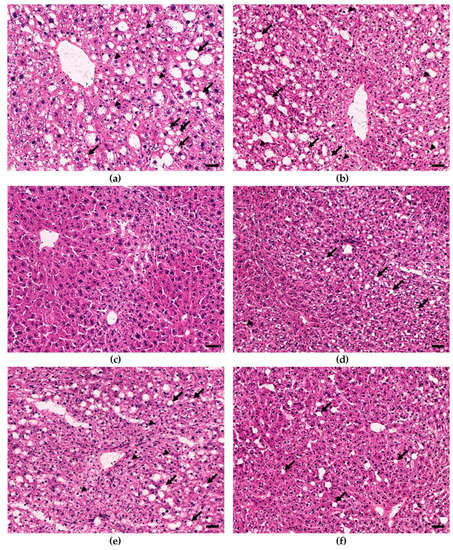 Thwarting Metabolic Dysfunction-Associated Fatty Liver Disease (MAFLD ...
