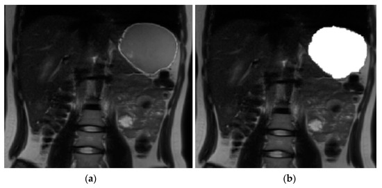 Gastric Emptying of New-World Milk Containing A1 and A2 Β-Casein Is ...