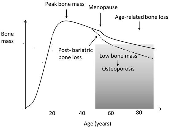 Postoperative Osteoporosis in Subjects with Morbid Obesity Undergoing ...