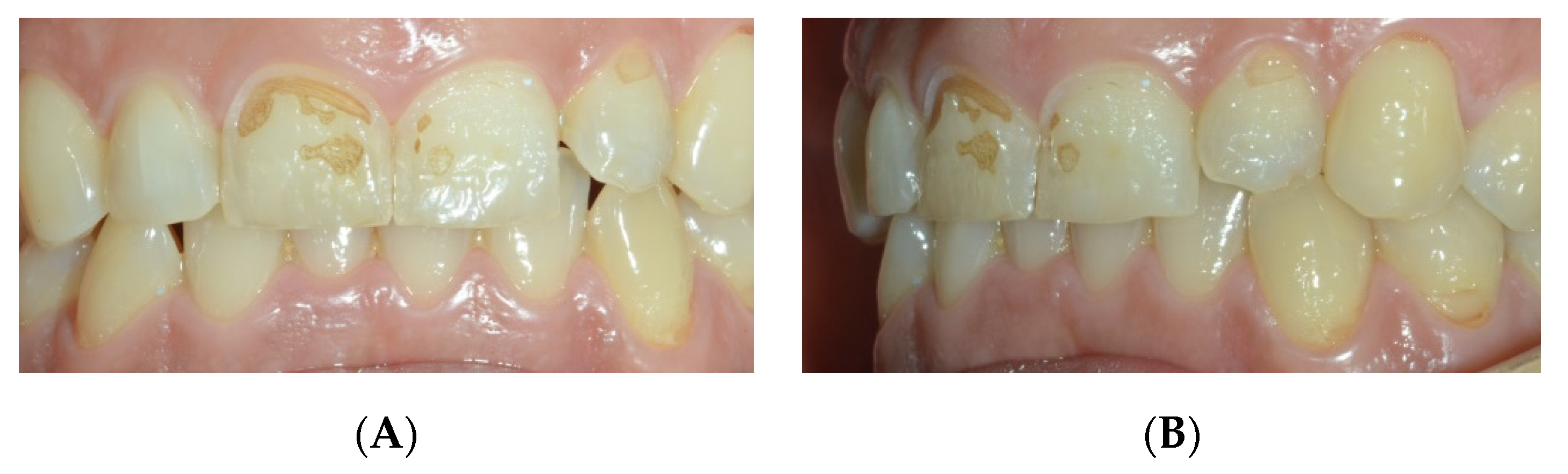 Damage from Carbonated Soft Drinks on Enamel: A Systematic Review