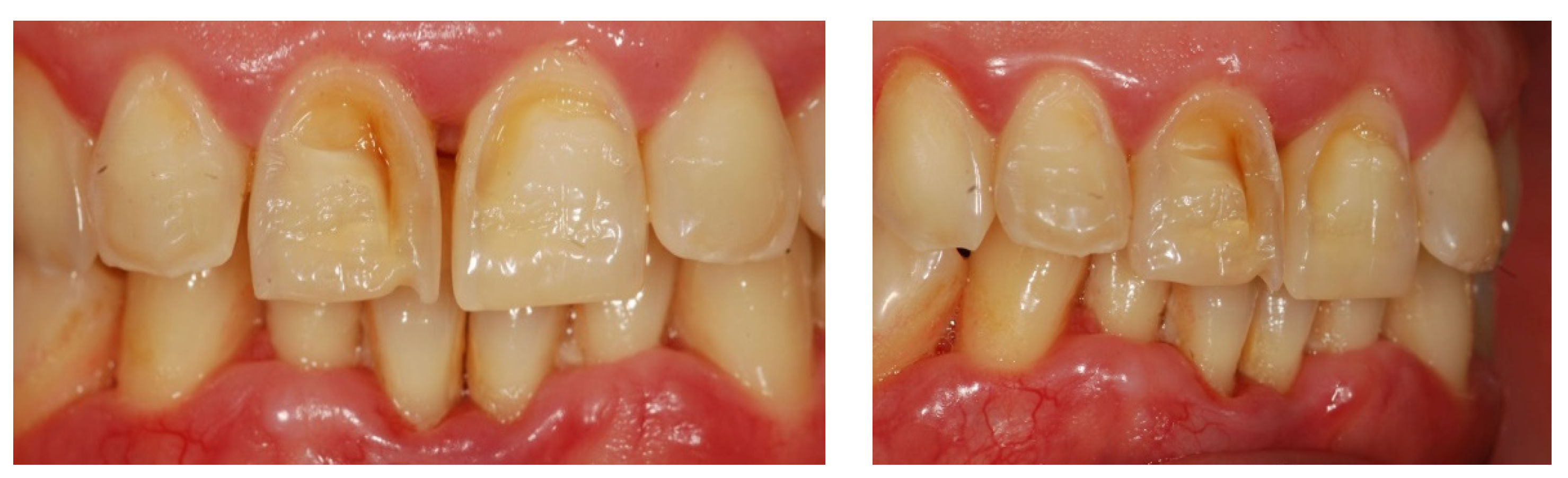 Damage from Carbonated Soft Drinks on Enamel: A Systematic Review