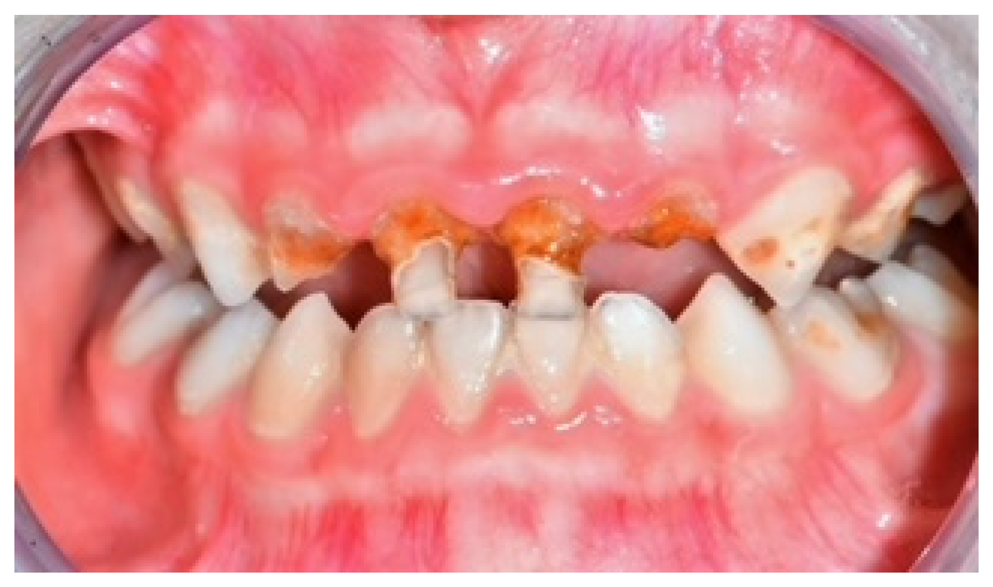 Damage from Carbonated Soft Drinks on Enamel: A Systematic Review