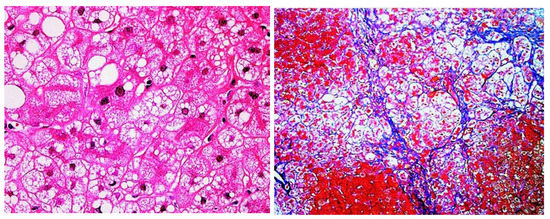 Citrin Deficiency: Clinical and Nutritional Features