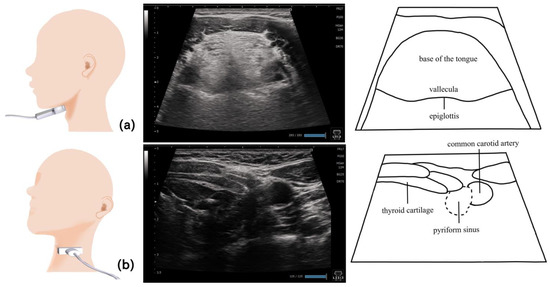 Ultrasonography for Eating and Swallowing Assessment: A Narrative ...