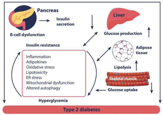 Sarcopenia as a Little-Recognized Comorbidity of Type II Diabetes ...