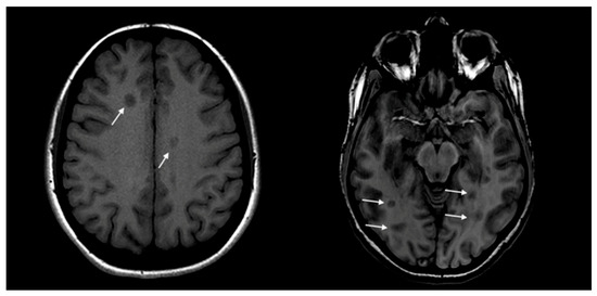 Pediatric Onset Multiple Sclerosis and Obesity: Defining the Silhouette ...