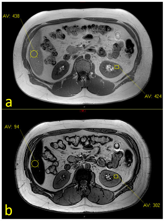 Obesity Is Associated with Fatty Liver and Fat Changes in the Kidneys ...