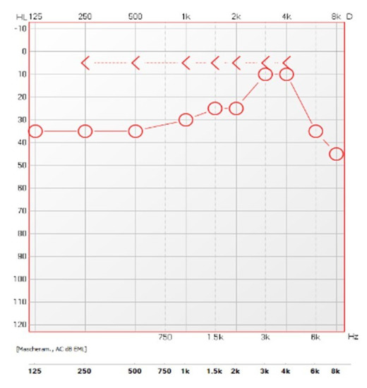 Tinnitus, Aural Fullness, and Hearing Loss in a Patient with Acoustic ...