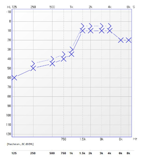 Tinnitus, Aural Fullness, and Hearing Loss in a Patient with Acoustic ...