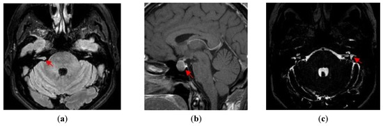 Tinnitus, Aural Fullness, and Hearing Loss in a Patient with Acoustic ...