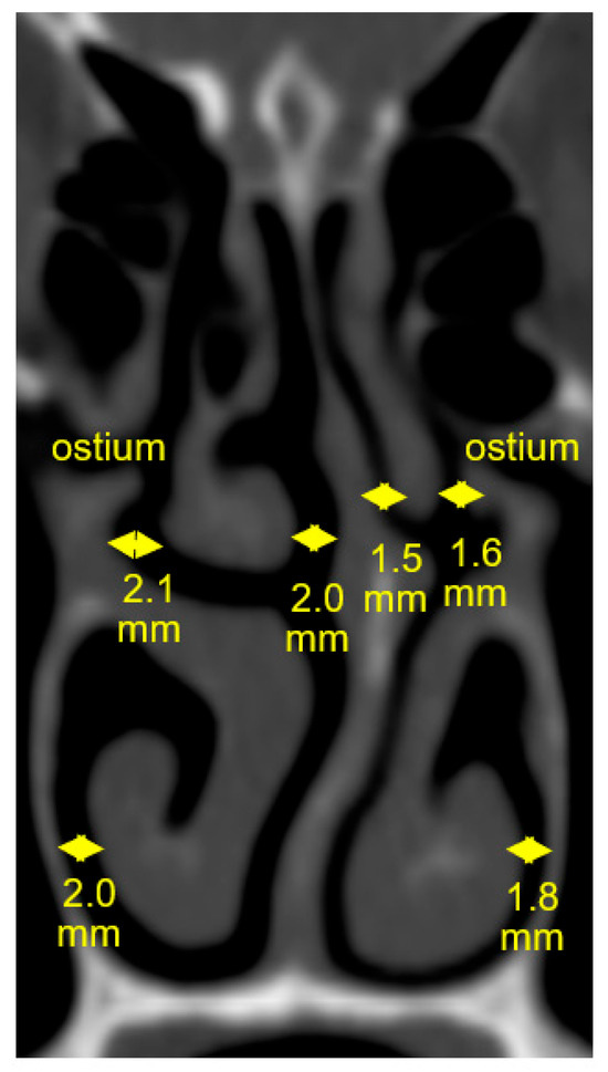 The Nasal Septal Swell Body May Have a Regulatory Role in Nasal Airway ...