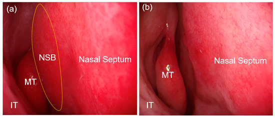 The Nasal Septal Swell Body May Have a Regulatory Role in Nasal Airway ...