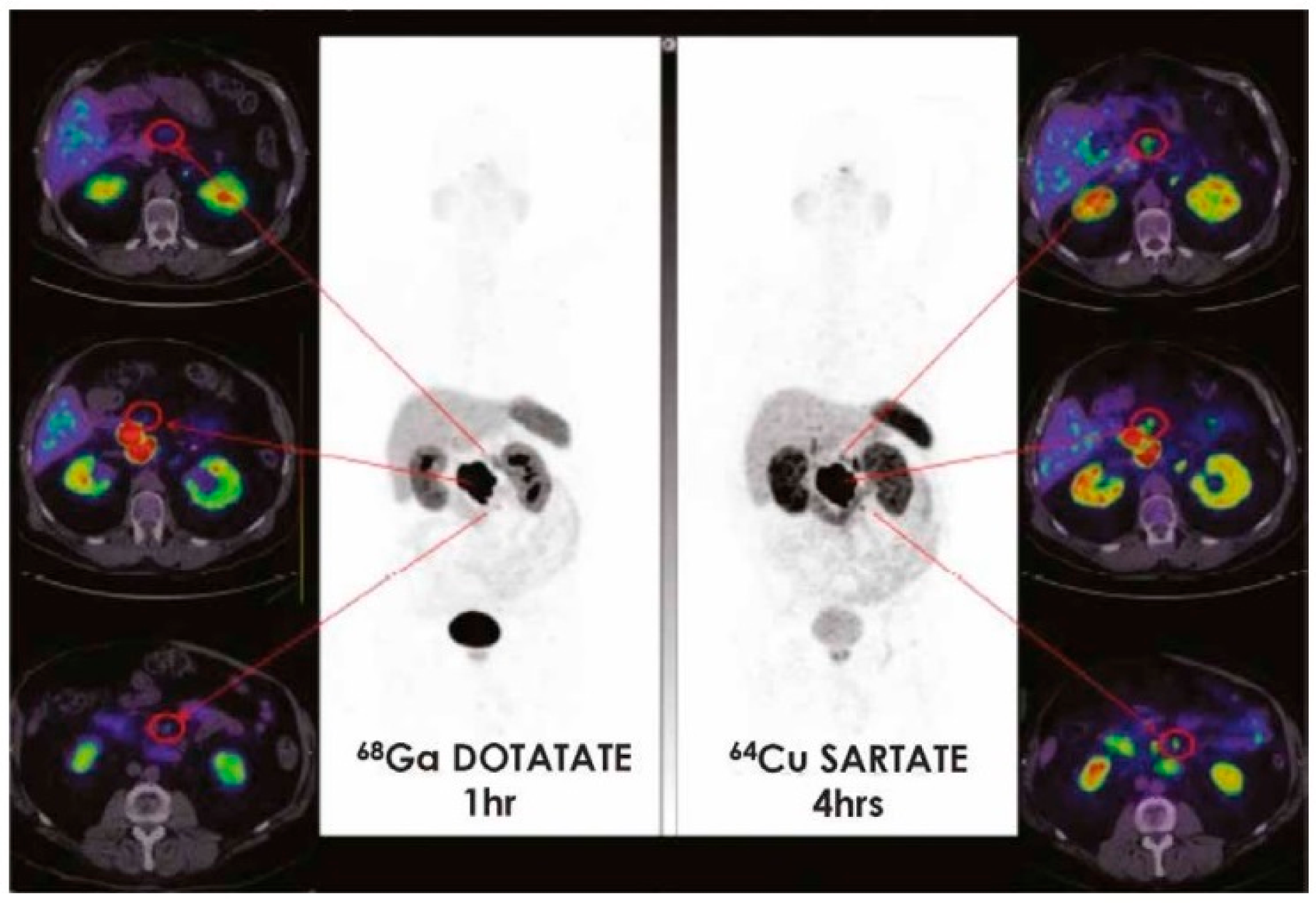 Radiotheranostic Agents Targeting Neuroblastoma: State-of-the-Art and ...