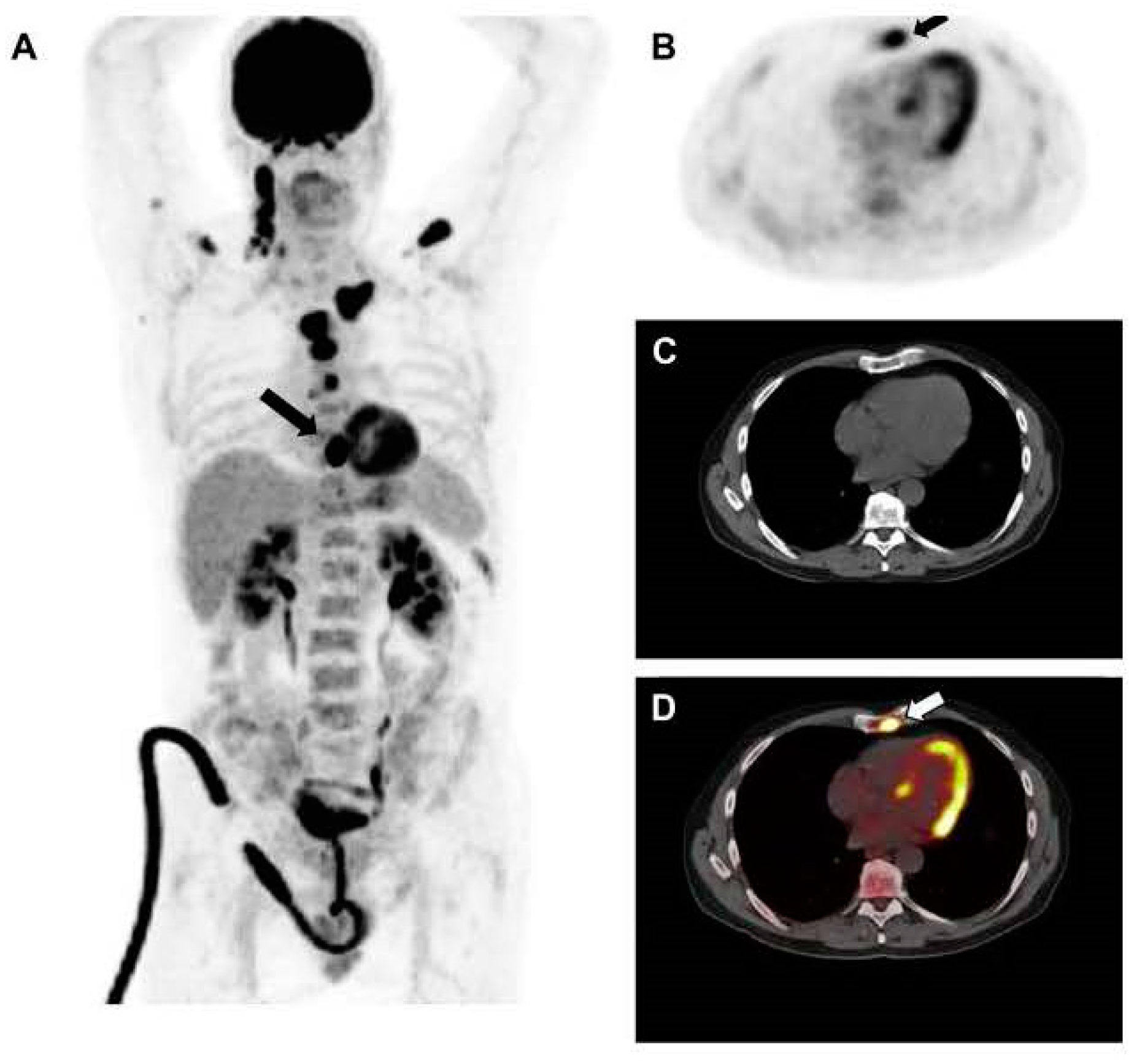 Significance of PET/CT Imaging in Myeloma Assessment: Exploring Novel ...