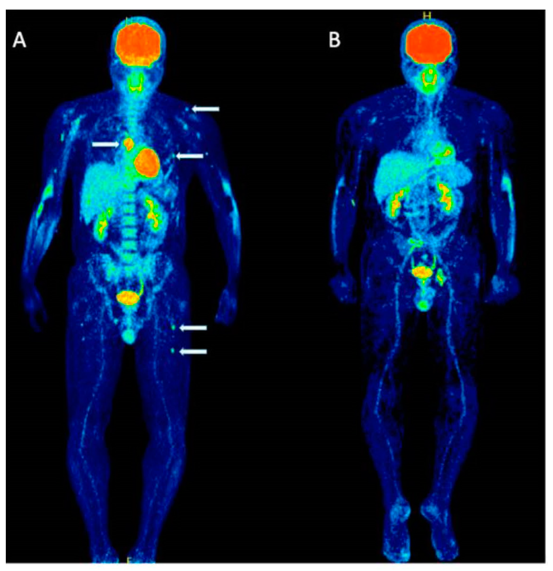 Significance of PET/CT Imaging in Myeloma Assessment: Exploring Novel Applications beyond ...