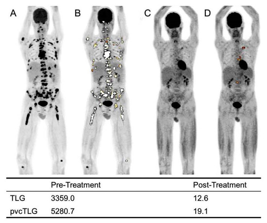 Significance of PET/CT Imaging in Myeloma Assessment: Exploring Novel ...