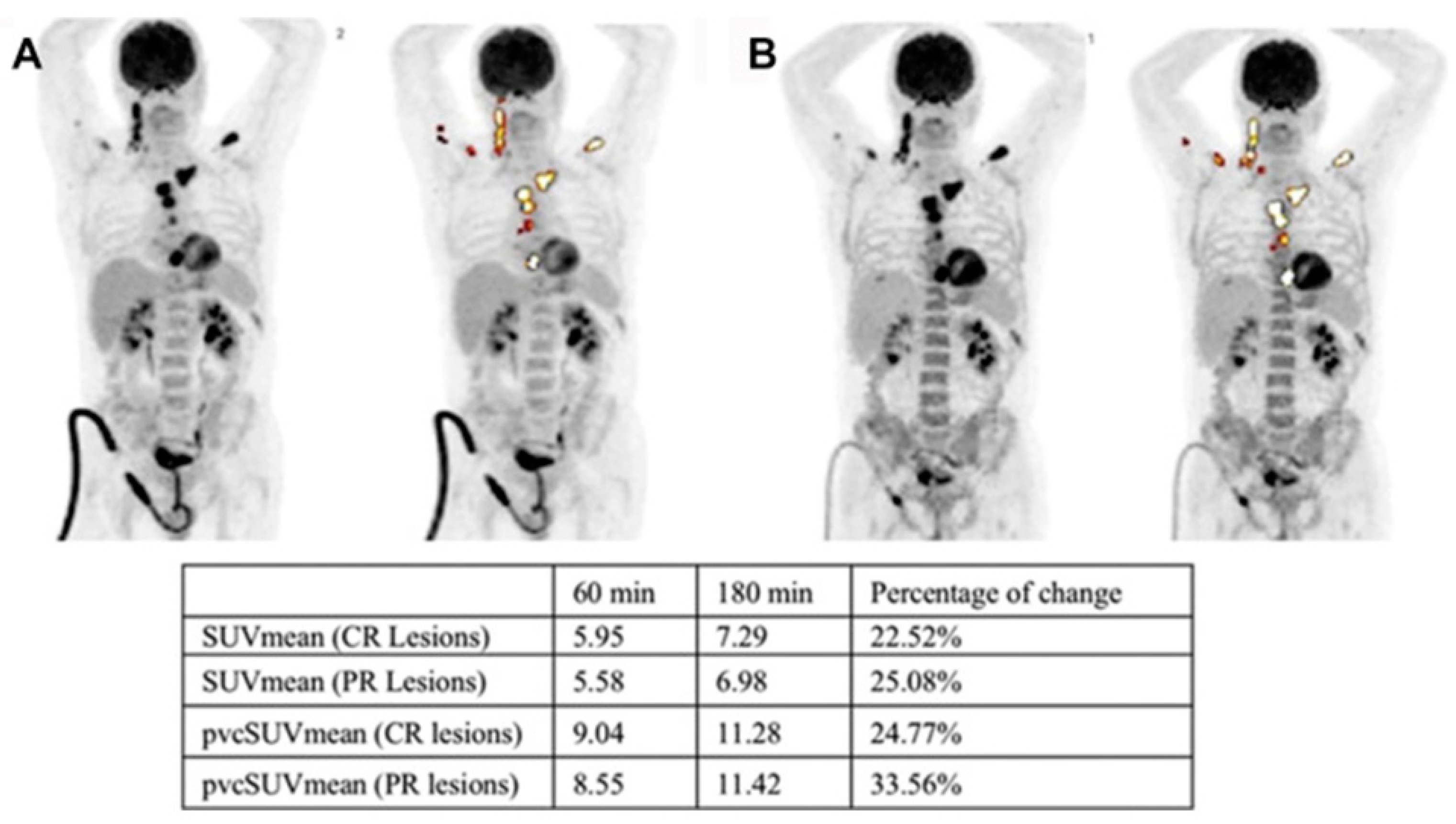 Significance of PET/CT Imaging in Myeloma Assessment: Exploring Novel Applications beyond ...