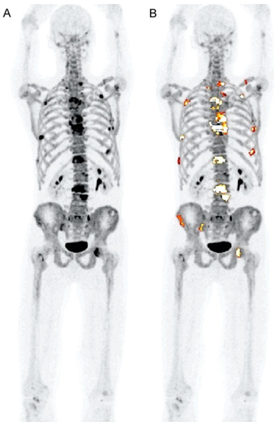 Significance of PET/CT Imaging in Myeloma Assessment: Exploring Novel ...
