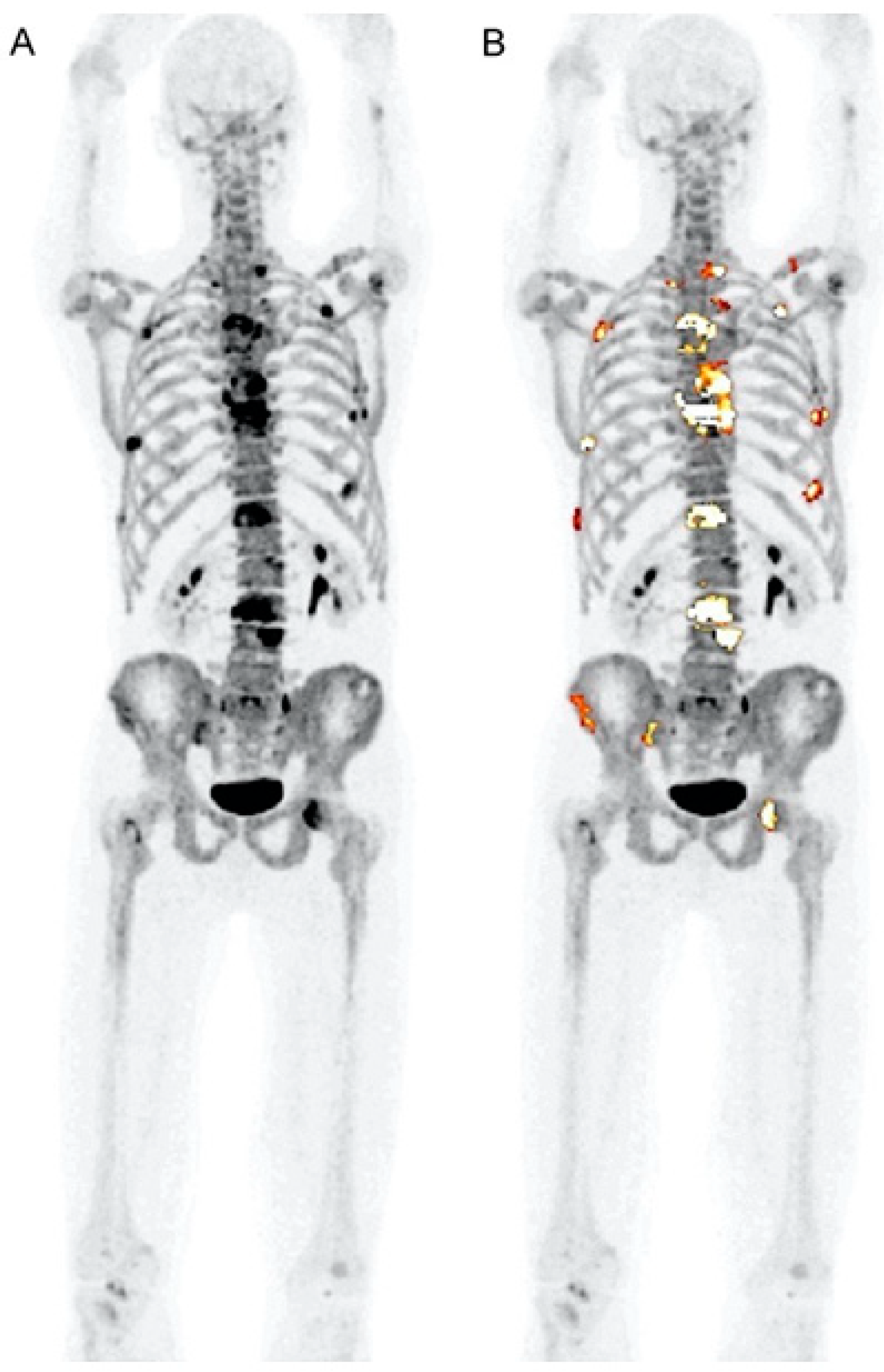 Significance of PET/CT Imaging in Myeloma Assessment: Exploring Novel ...
