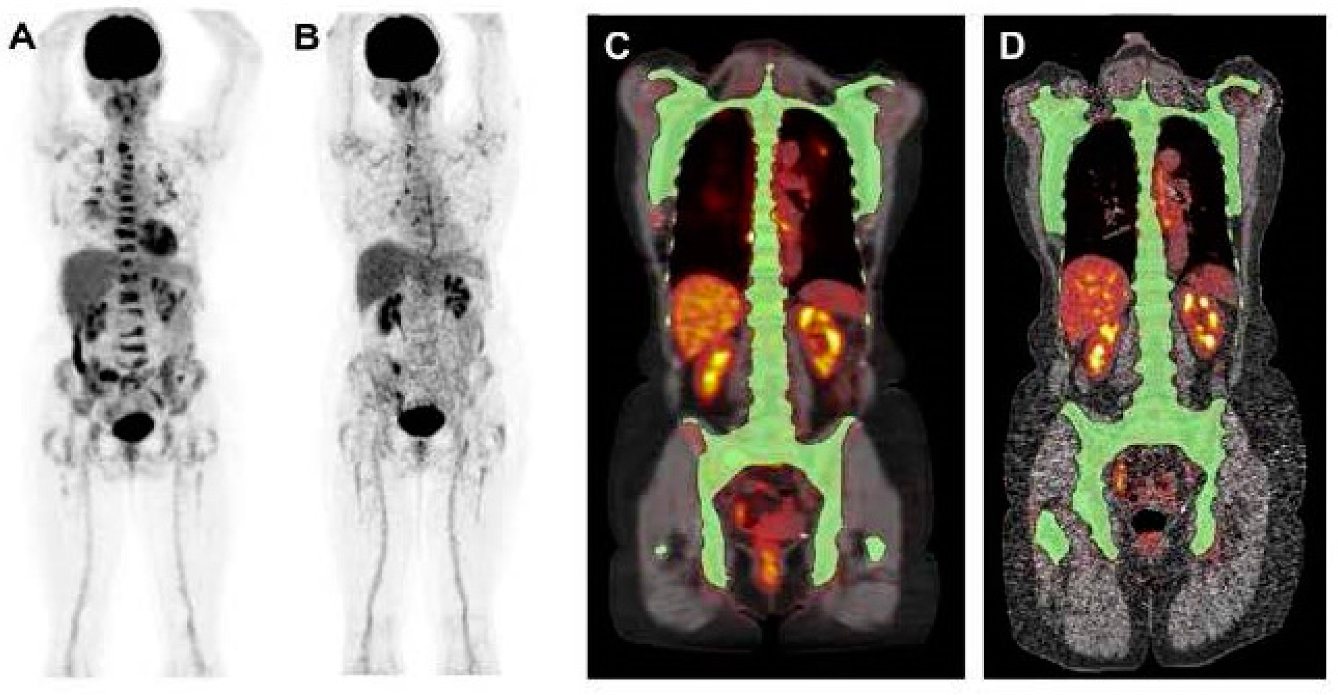 Significance of PET/CT Imaging in Myeloma Assessment: Exploring Novel ...