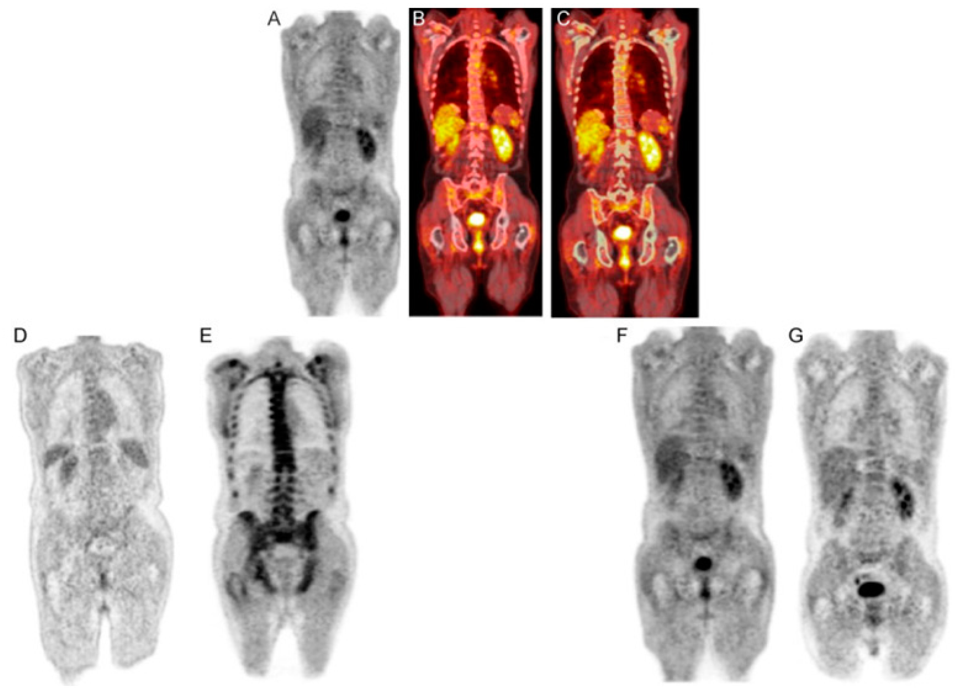 Significance of PET/CT Imaging in Myeloma Assessment: Exploring Novel ...