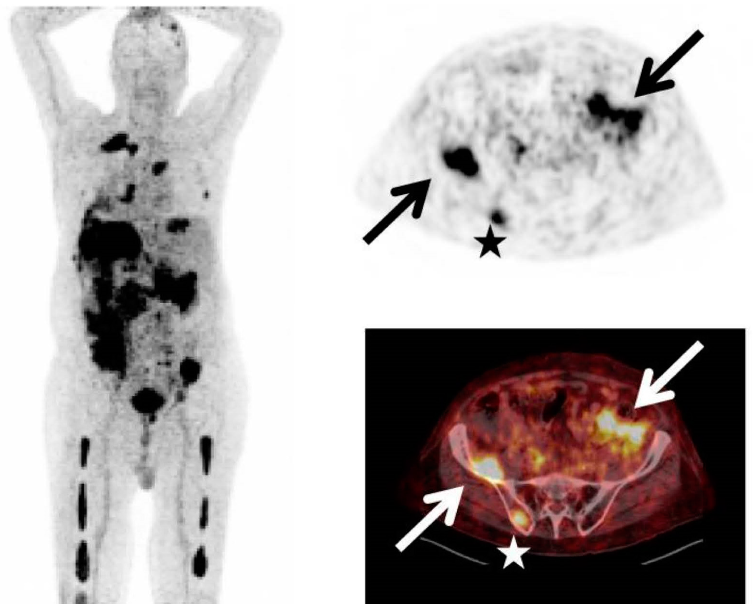 Significance of PET/CT Imaging in Myeloma Assessment: Exploring Novel ...