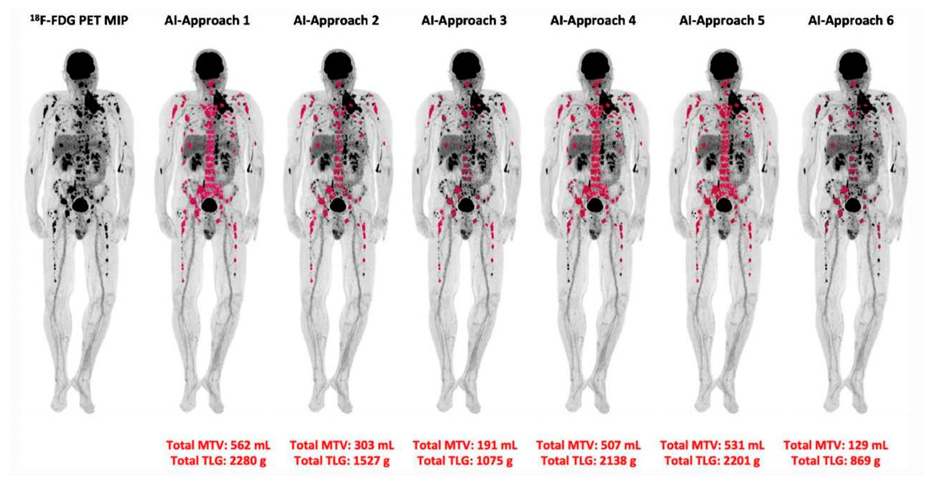 Significance of PET/CT Imaging in Myeloma Assessment: Exploring Novel Applications beyond ...