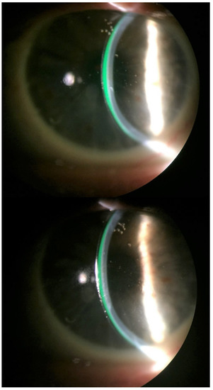 Rigid Gas-Permeable Semi-Scleral Contact Lenses after Radial Keratotomy ...