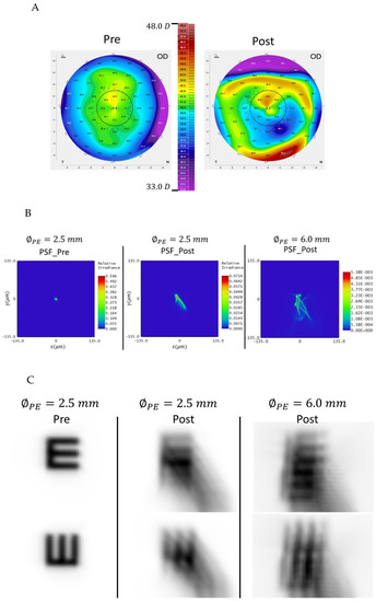 Understanding the Real Effect of the High-Order Aberrations after Myopic Femto-Lasik