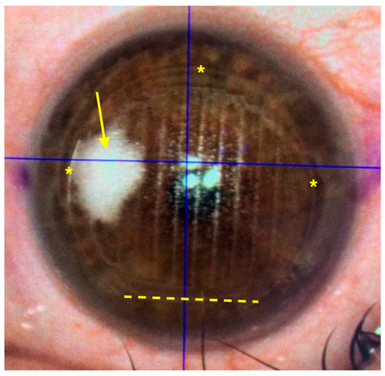 Creation of a Corneal Flap for Laser In Situ Keratomileusis Using a ...