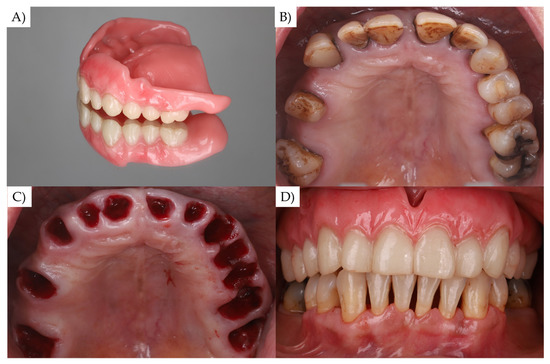 From Denture to the Final Implant-Supported Prosthesis Using a Full ...
