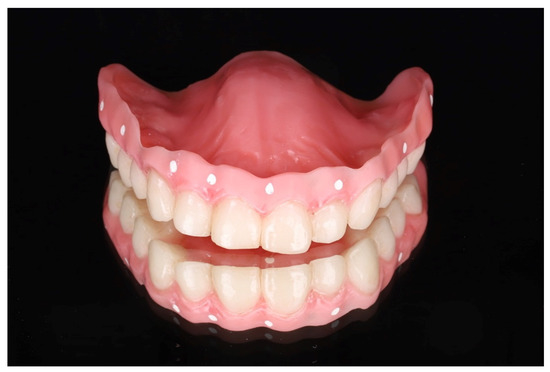 From Denture to the Final Implant-Supported Prosthesis Using a Full ...