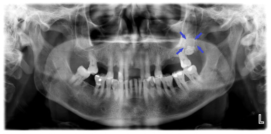 Maxillary Distomolar Associated with Dentigerous Cyst: An Unusual Entity