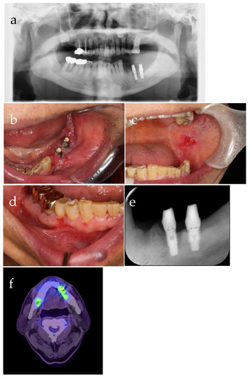 Mandibular Carcinoma Cuniculatum around the Dental Implant in a Patient ...