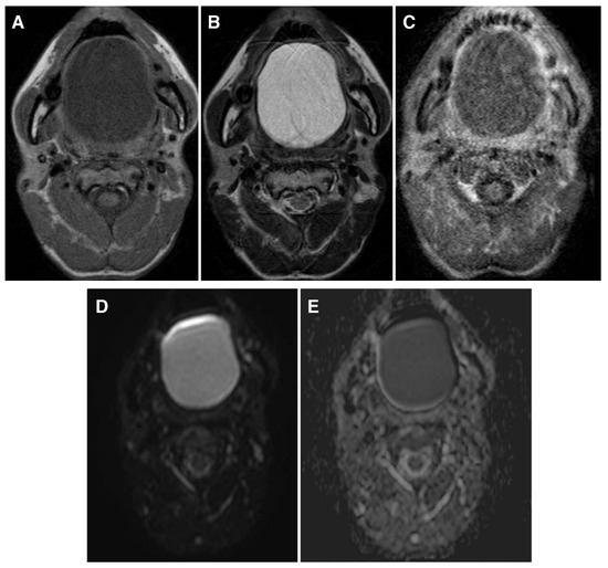 Cystic Lesions In Floor Of Mouth Radiology